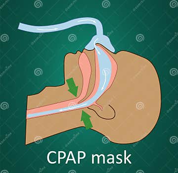 Vector Illustration of Breathing with CPAP Mask. Stock Vector ...