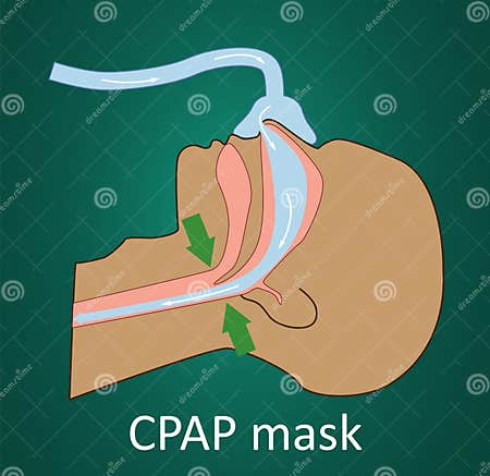 Vector Illustration of Breathing with CPAP Mask. Stock Vector ...