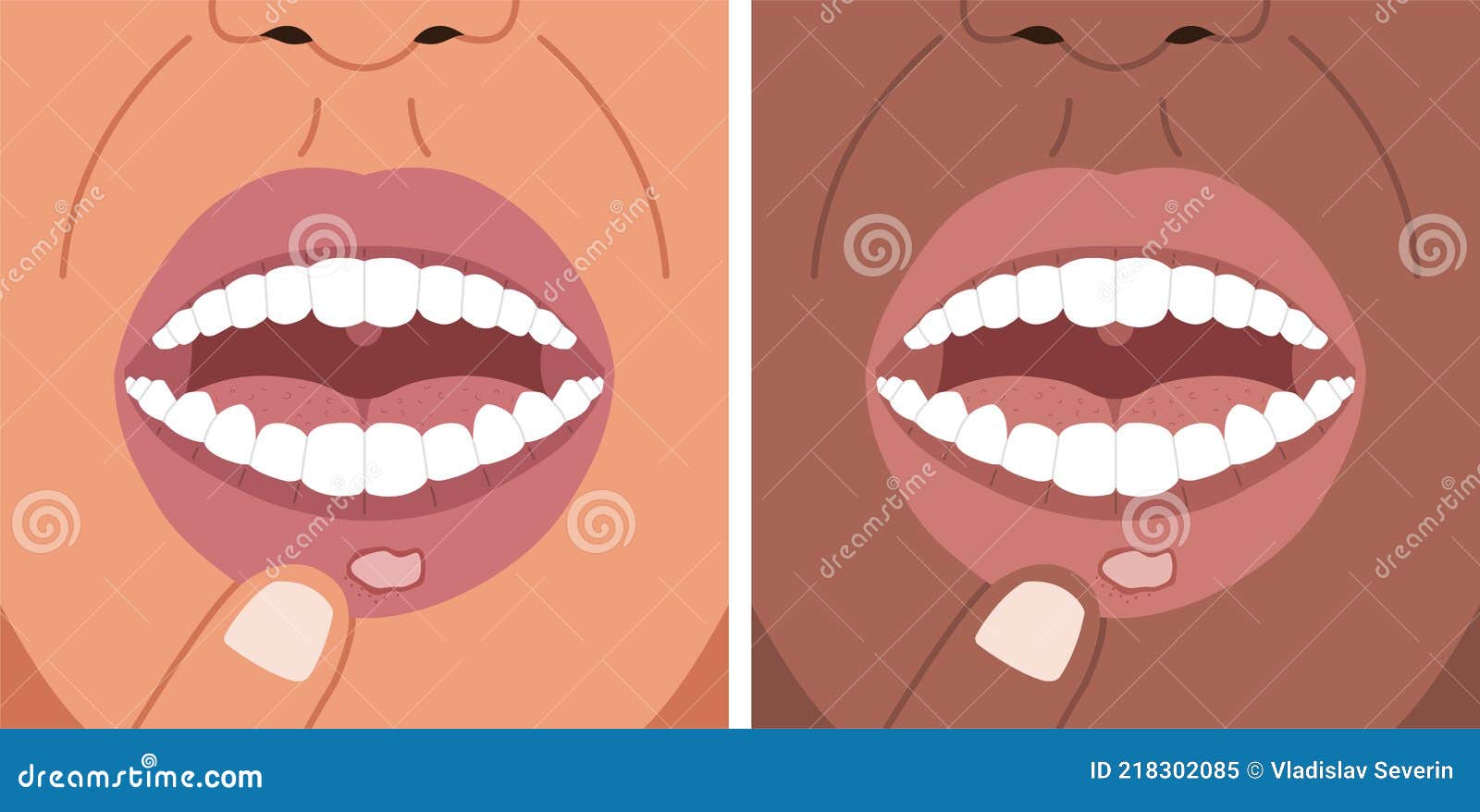 Vector Illustration Canker Sore, Aphthous Ulcer on the Lip Stock Vector ...