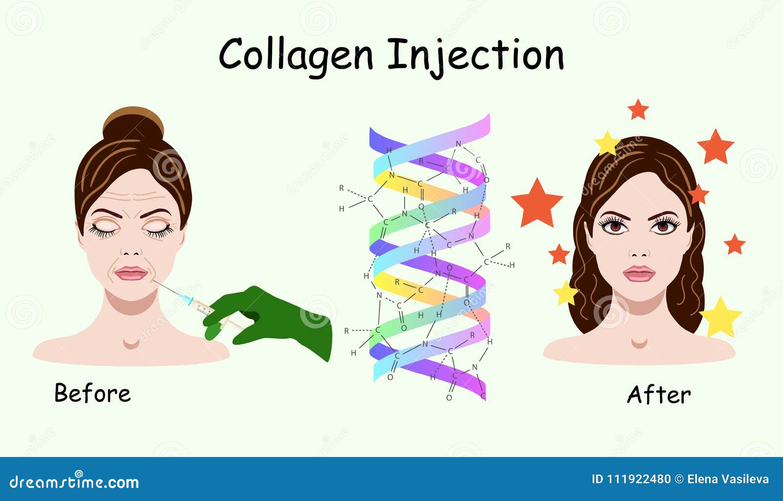 Vector Illustration with Collagen Injection Process on the White ...
