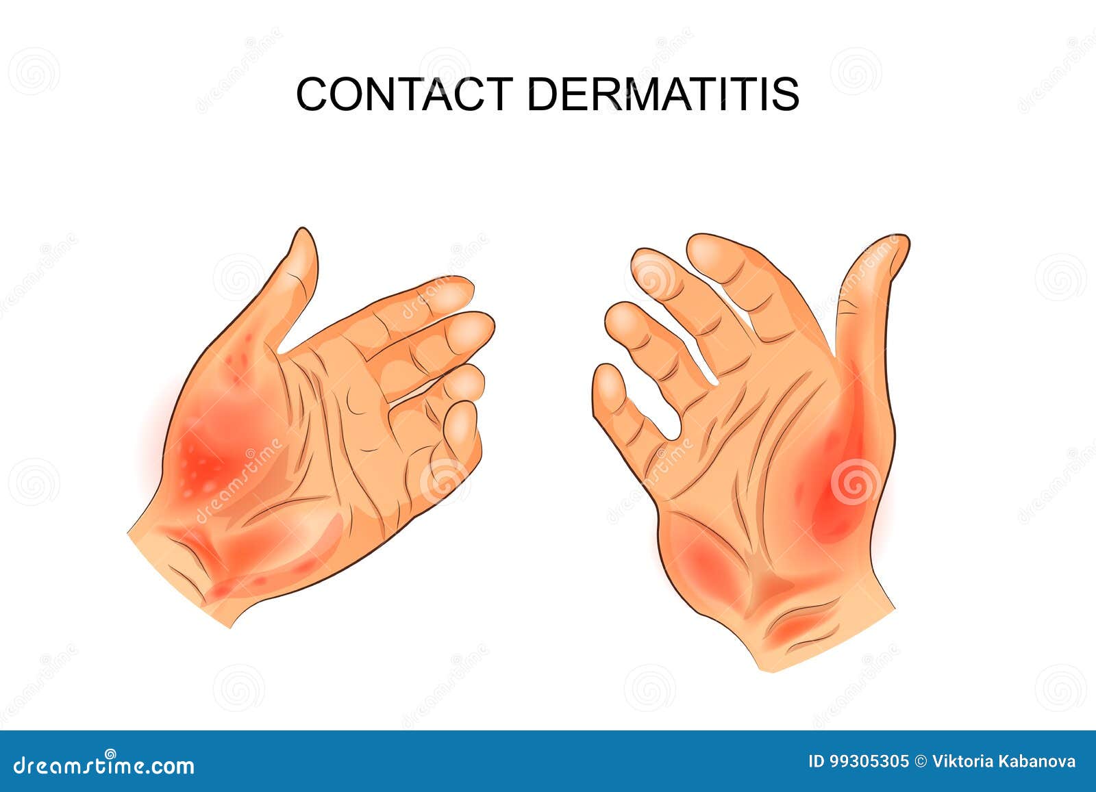 Dermatitis Cartoons Illustrations And Vector Stock Images 4540