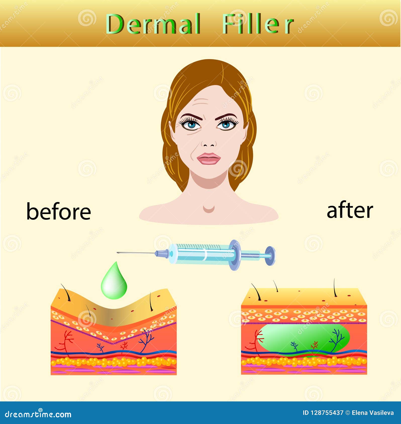 Cosmetic Filler Or Dermal Fillers Vector Illustration | CartoonDealer ...