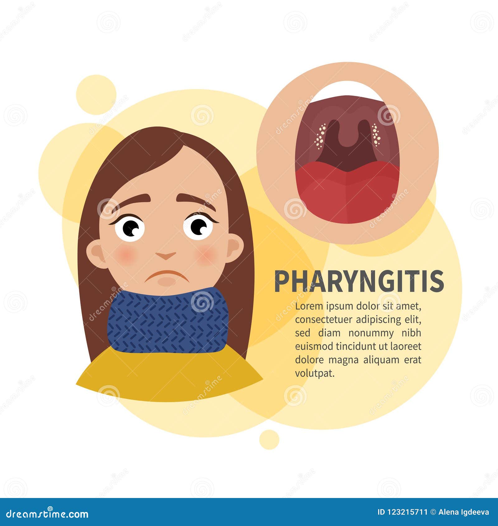 Pharyngitis Vector Illustration | CartoonDealer.com #29708128