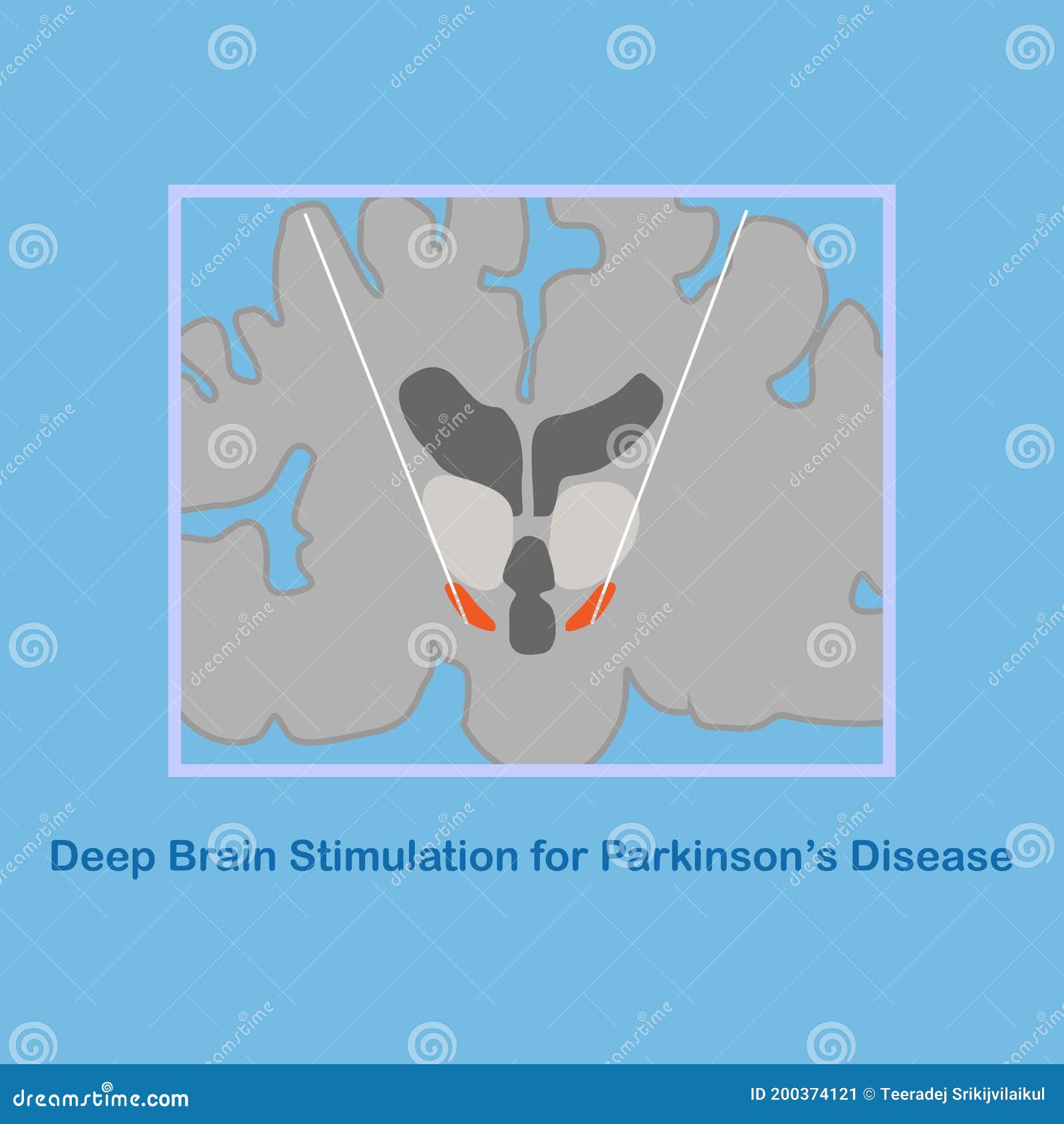 Deep Brain Stimulation Procedure Educational Explanation Outline ...