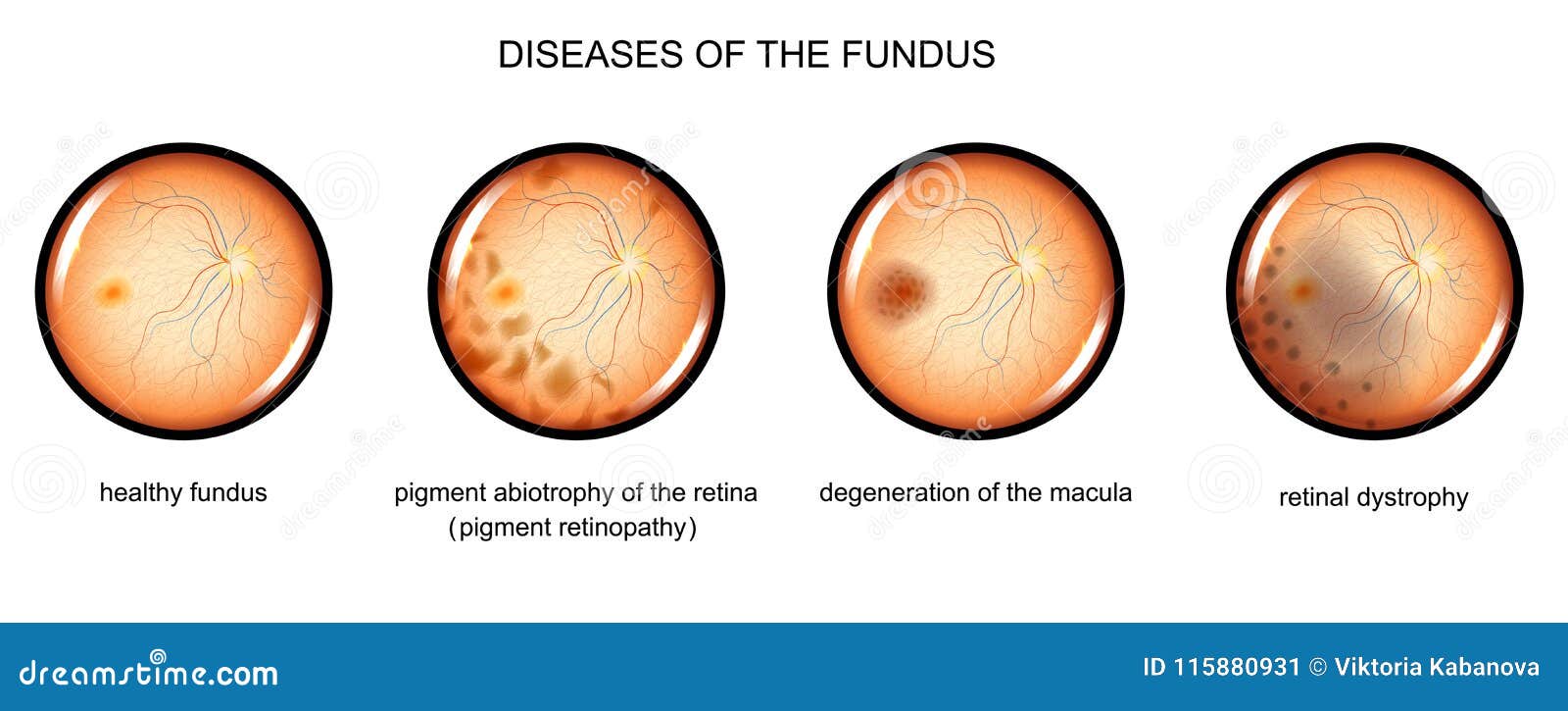 Degenerative Diseases of the Fundus Stock Vector - Illustration of ...