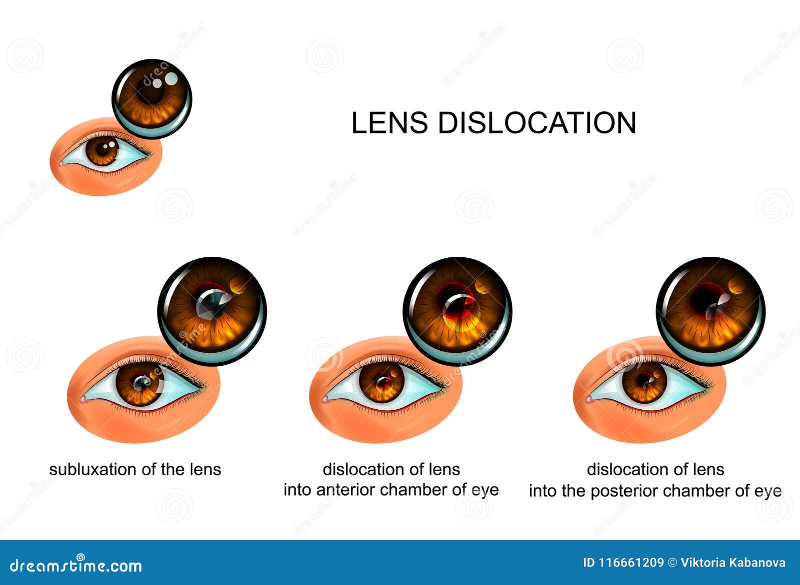 Dislocation of the Lens of the Eye Stock Vector - Illustration of iris ...