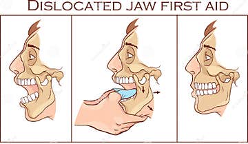 Vector Illustration of a First Aid Dislocated Jaw Stock Vector ...