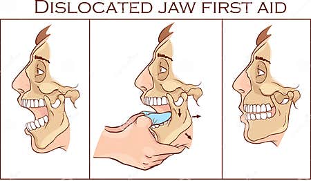 Vector Illustration of a First Aid Dislocated Jaw Stock Vector ...