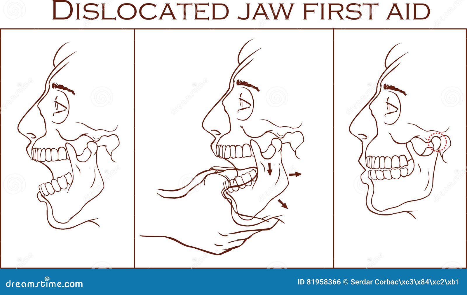 Dislocated Jaw Stock Illustrations – 10 Dislocated Jaw Stock ...