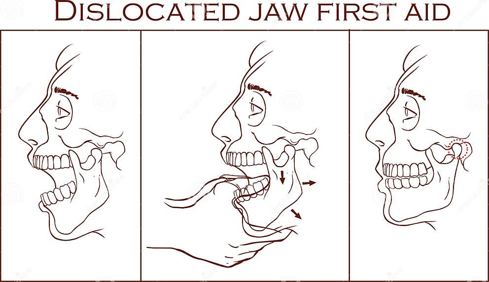 Vector Illustration of a First Aid Dislocated Jaw Stock Vector ...