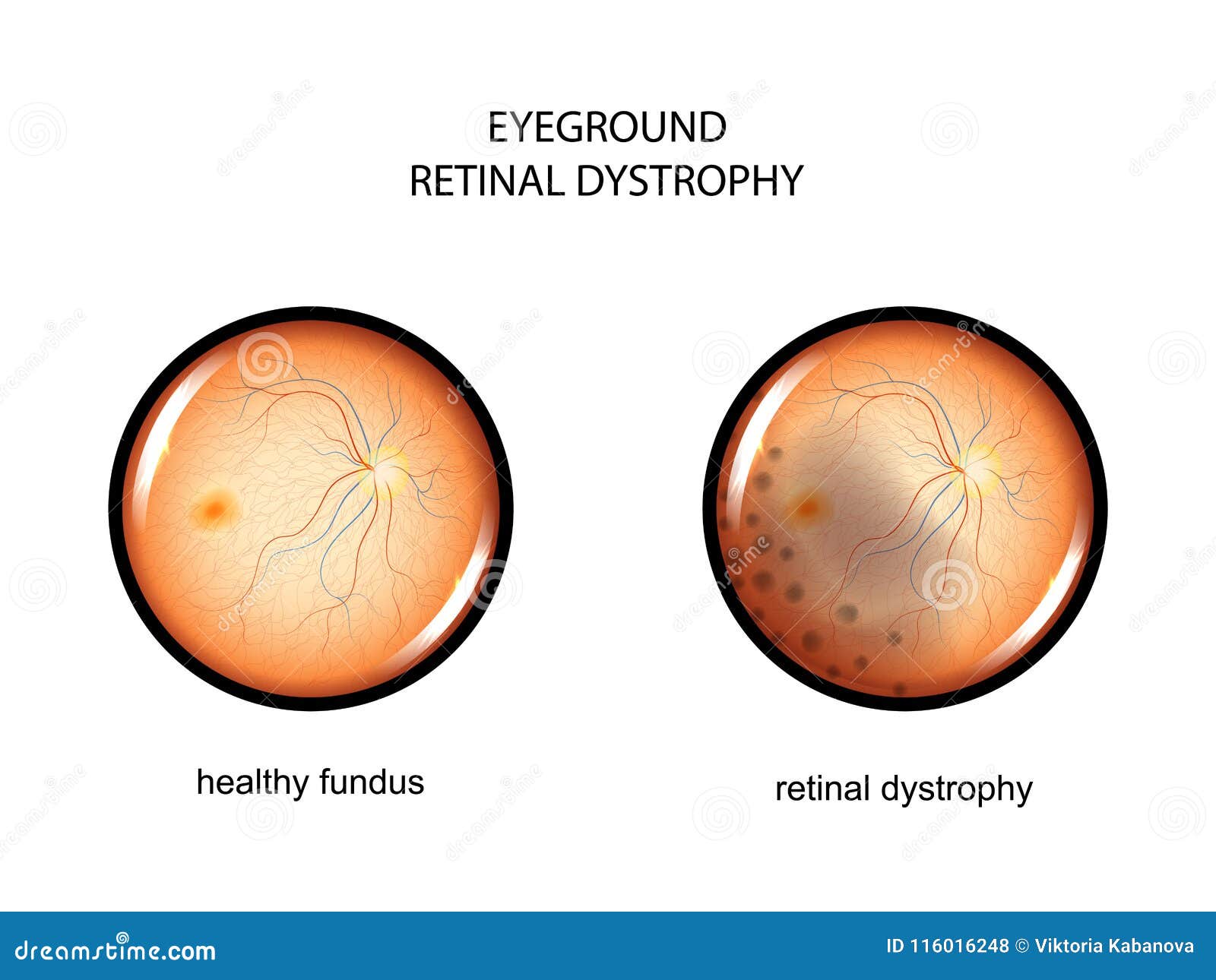Retinal Cartoons, Illustrations & Vector Stock Images - 3559 Pictures ...