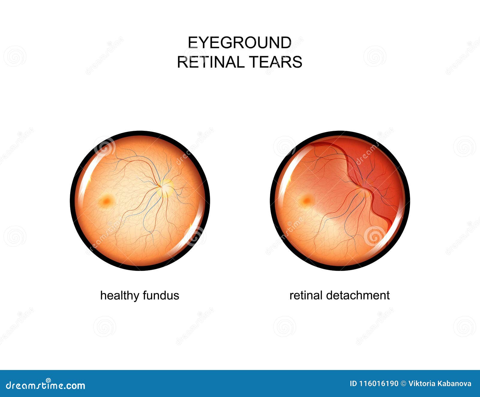 Retinal Cartoons, Illustrations & Vector Stock Images - 964 Pictures to ...