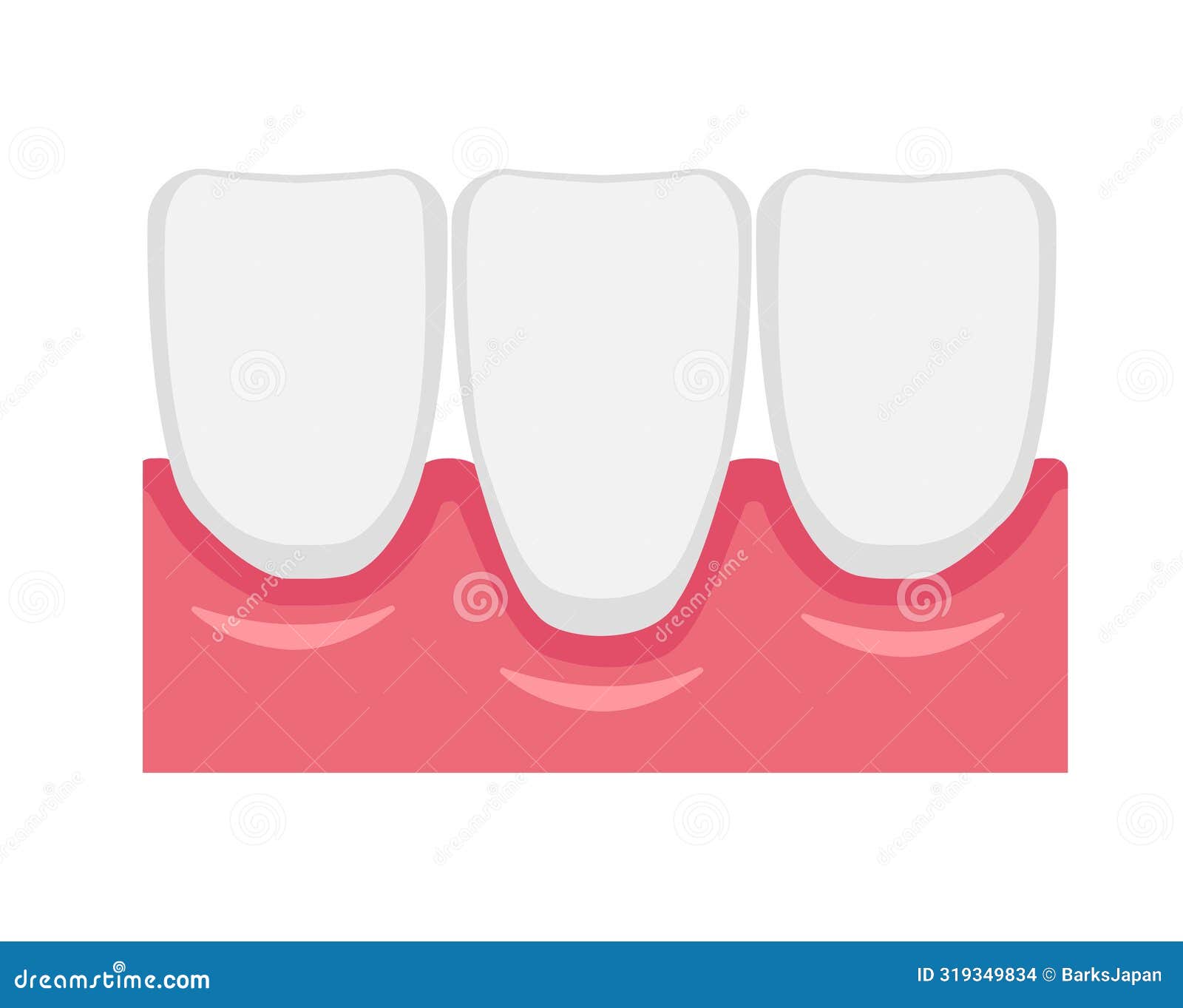 Vector Illustration of Gingival Recession Stock Vector - Illustration ...
