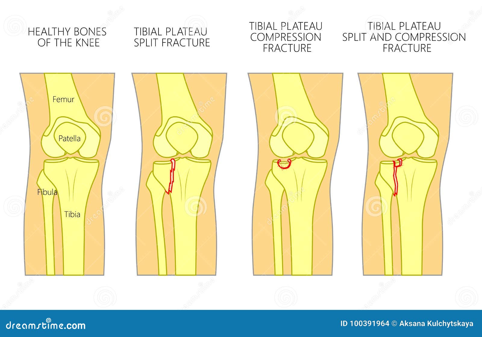 Fracture Tibial Plateau Stock Images by Megapixl