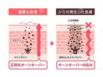 Illustration of How Skin Spots (hyperpigmentation) are Created Stock ...