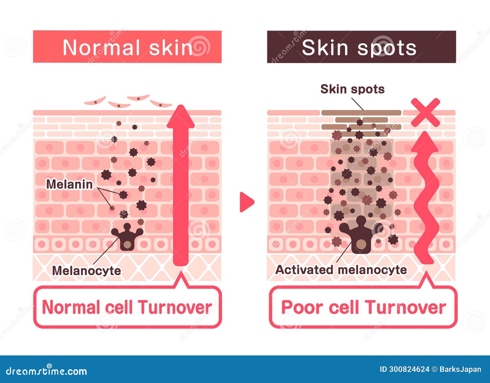 Illustration of How Skin Spots (hyperpigmentation) are Created Stock ...