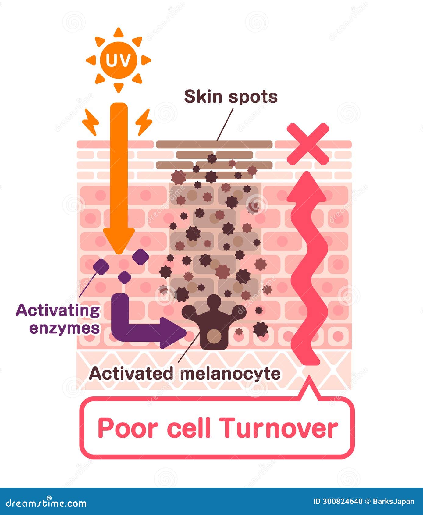 Illustration of How Skin Spots (hyperpigmentation) are Created Stock ...
