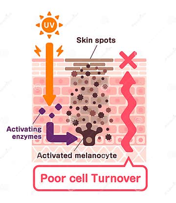 Illustration of How Skin Spots (hyperpigmentation) are Created Stock ...