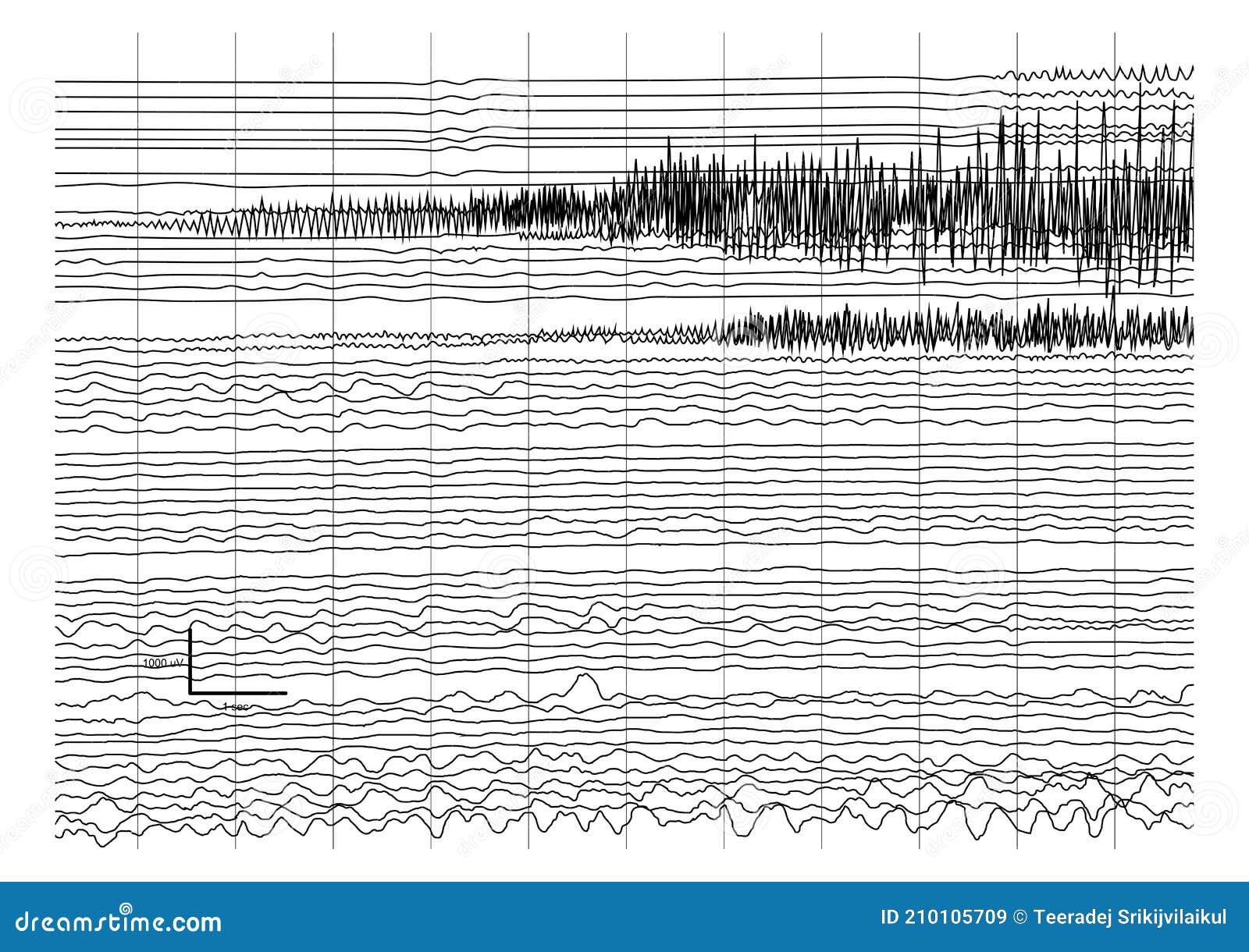 Vector Illustration of Ictal EEG Recording during Seizure Stock Vector ... Vector Illustration of Ictal EEG Recording during Seizure Stock Vector ...