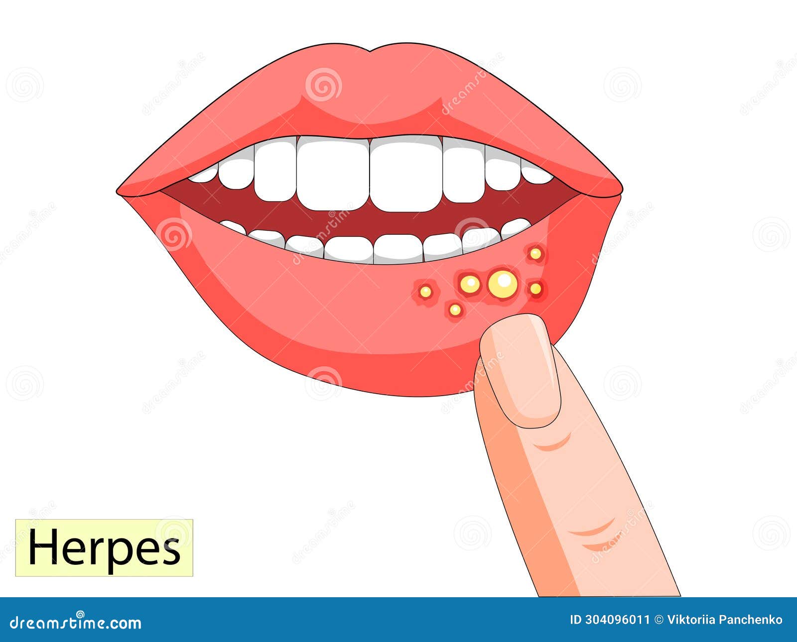 Illustration of Infection on Female Lips. Herpes Stock Vector ...