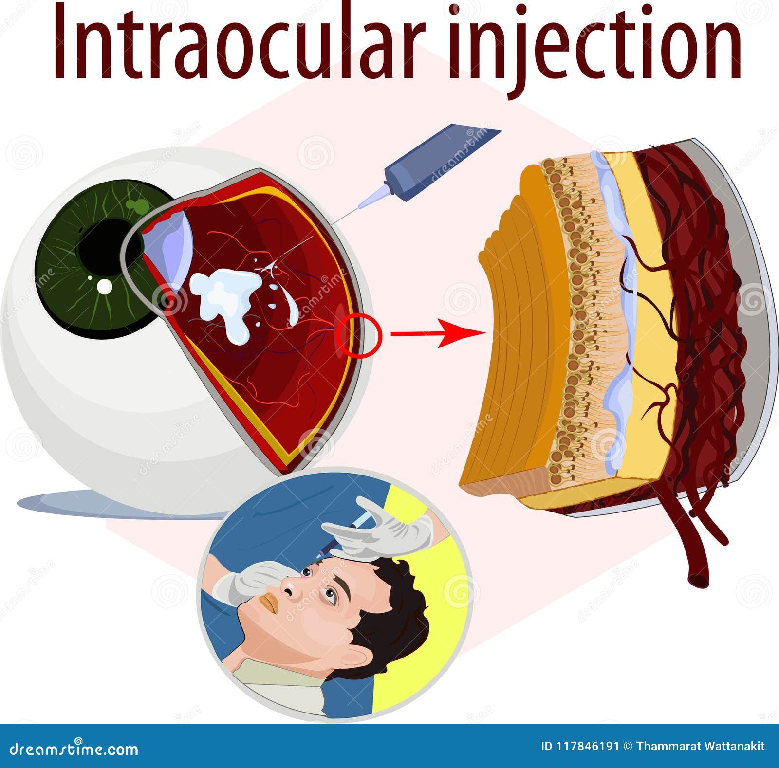 Vector Illustration of Intraocular Injection. Stock Illustration ...
