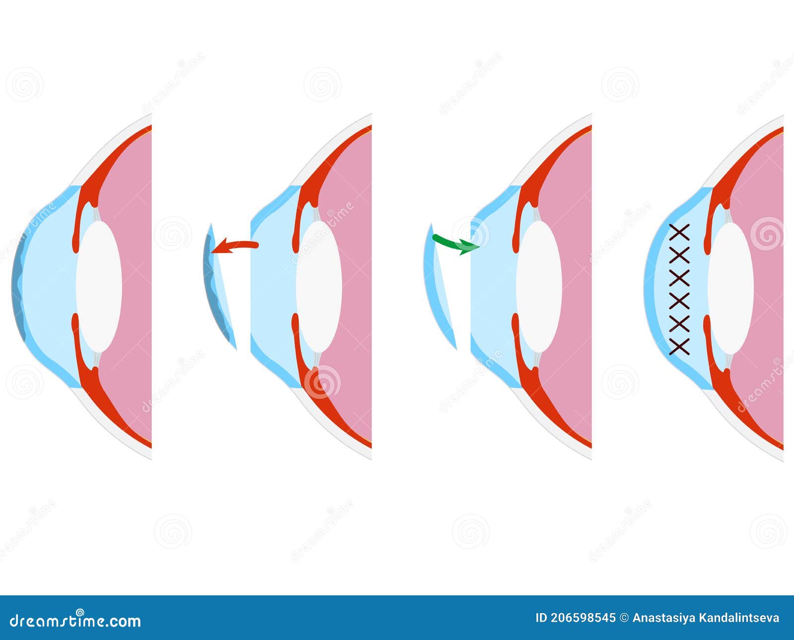 Vector Illustration: Keratoplasty. Corneal Surgery. Eye Surgery Royalty ...