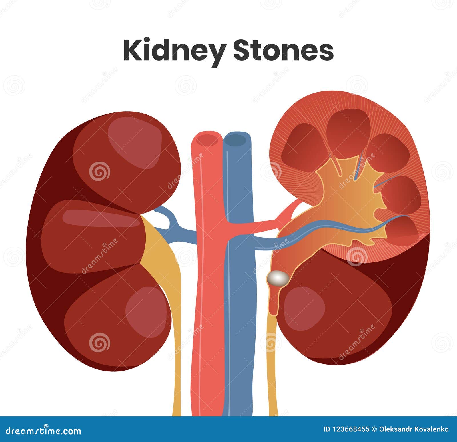 Nephrolithiasis Cartoons, Illustrations & Vector Stock Images - 318 ...