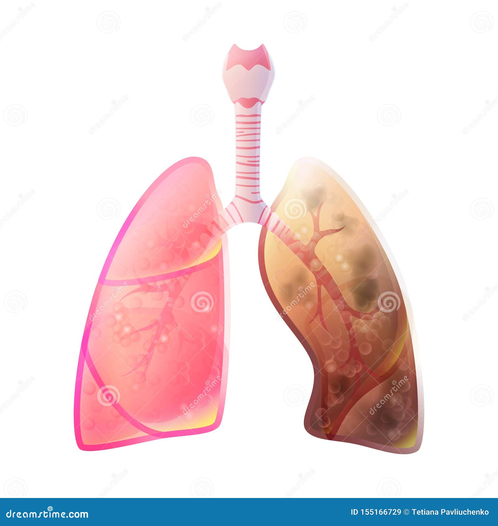 Vector Illustration Of Lung Cancer Stock Vector Illustration Of Body