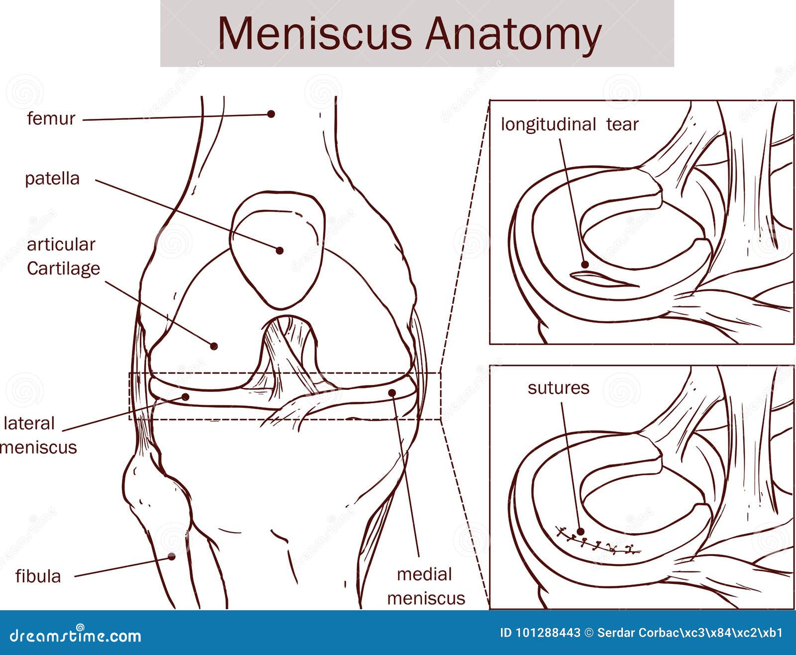 Vector Illustration of a Meniscus Tear and Surgery Stock Vector ...