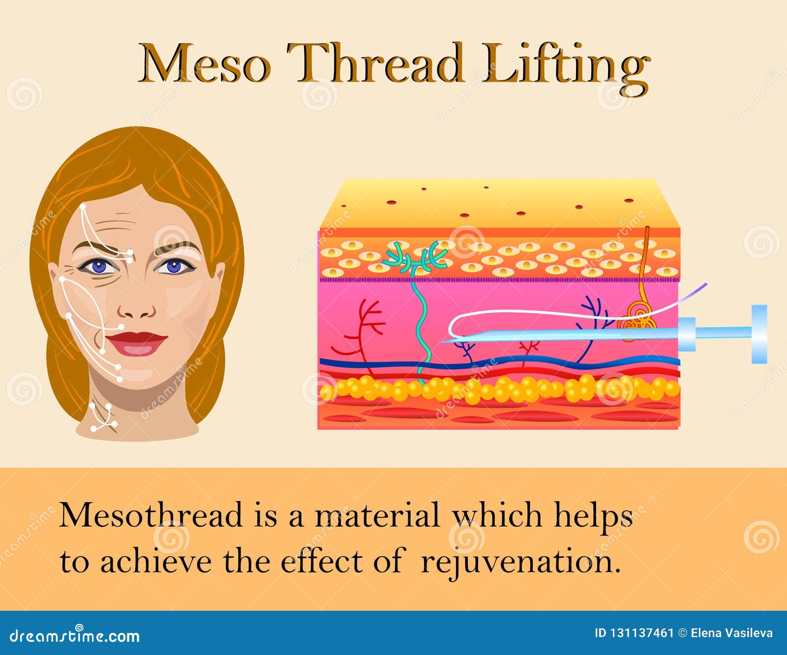 Mesotherapy Threads Lifting. Different Types Of Threads For Facelift ...