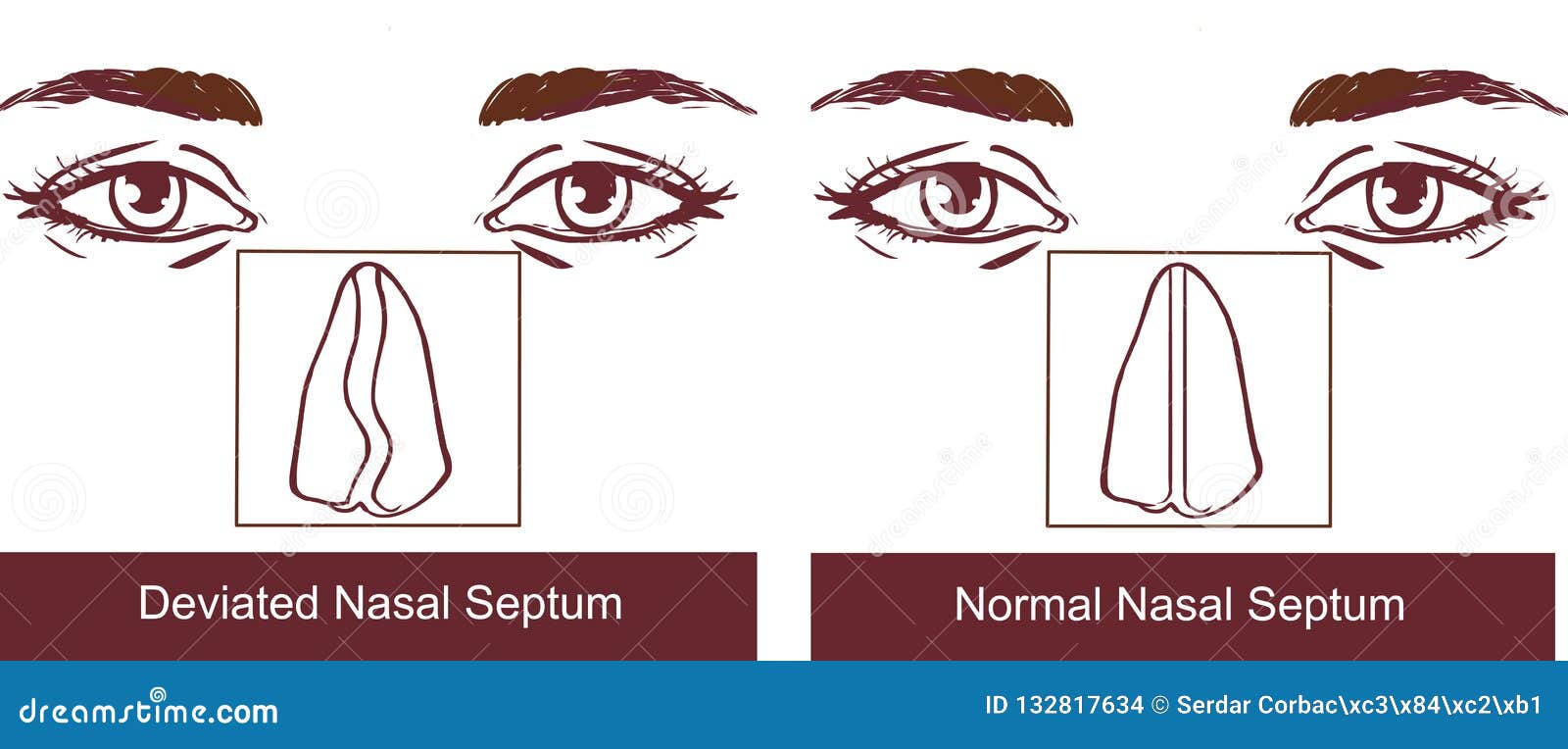 Vector Illustration of a Nasal Septum Deviation Treatmen Stock Vector ...