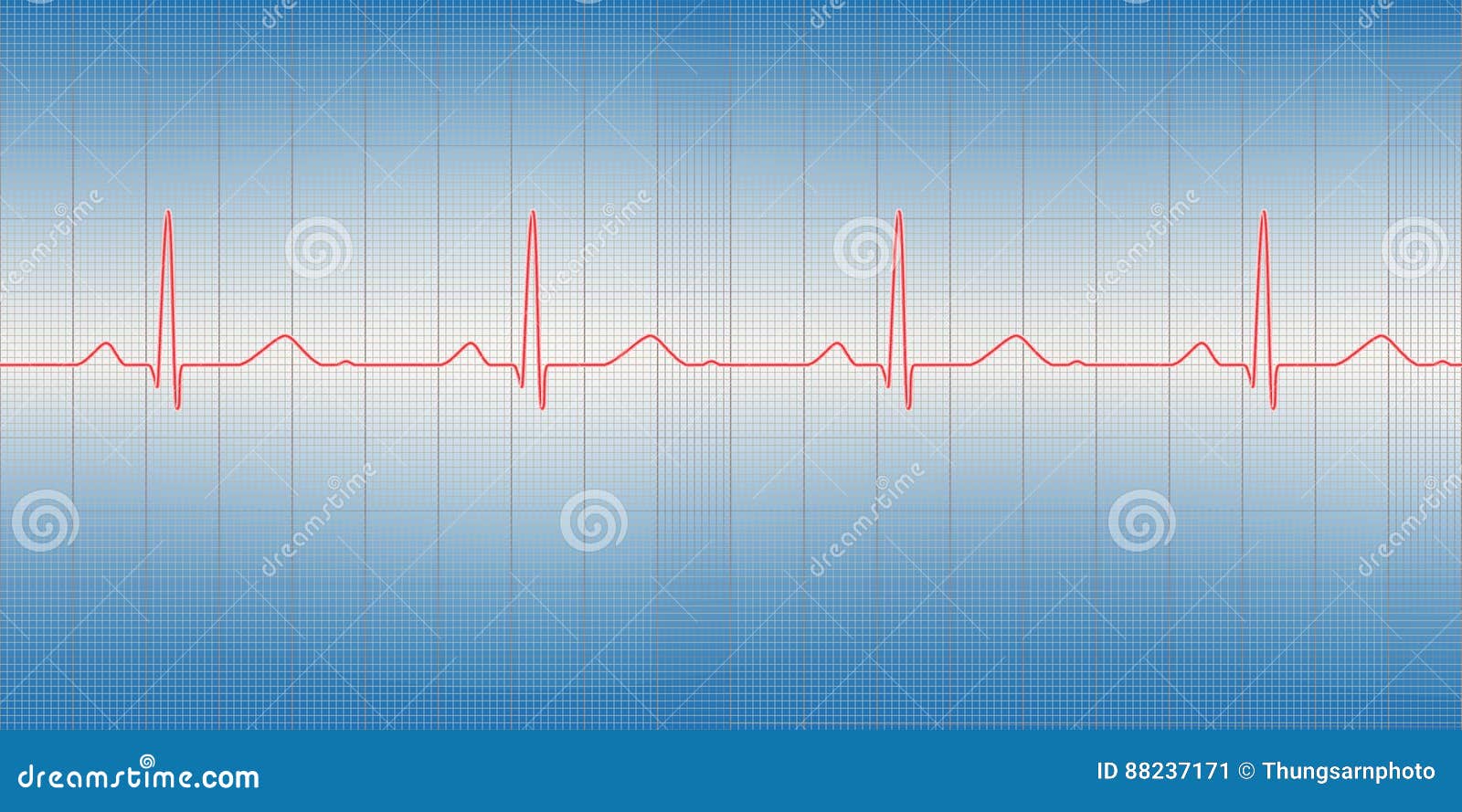 Vector Illustration of Normal Cardiogram Stock Illustration ...