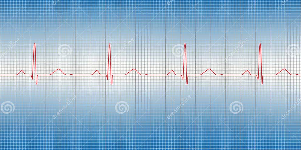 Vector Illustration of Normal Cardiogram Stock Illustration ...
