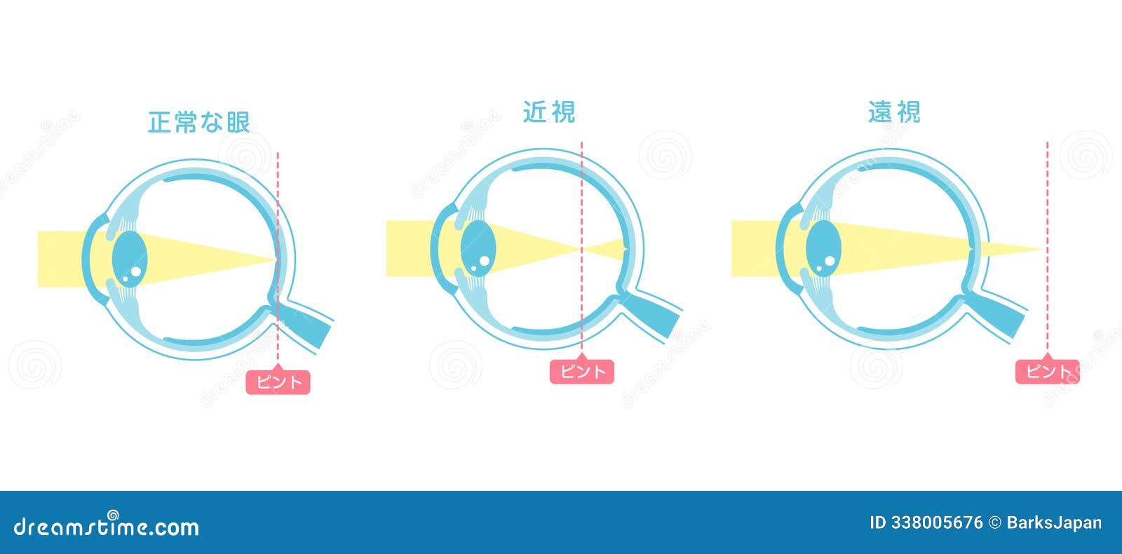 Vector Illustration of Normal Vision and Myopia and Hyperopia Stock ...