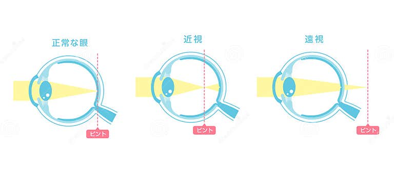 Vector Illustration of Normal Vision and Myopia and Hyperopia Stock ...