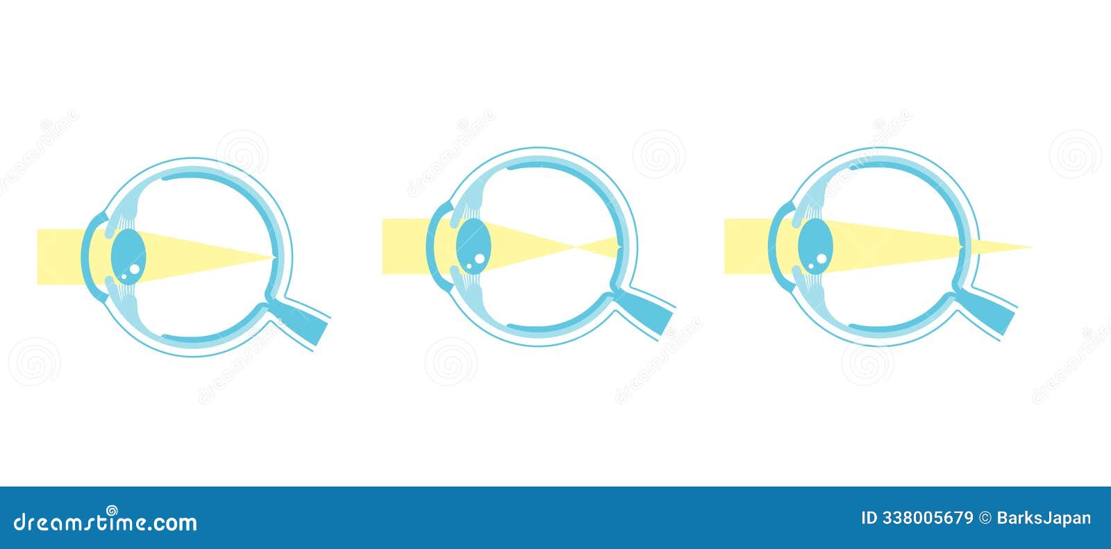 Vector Illustration of Normal Vision and Myopia and Hyperopia Stock ...
