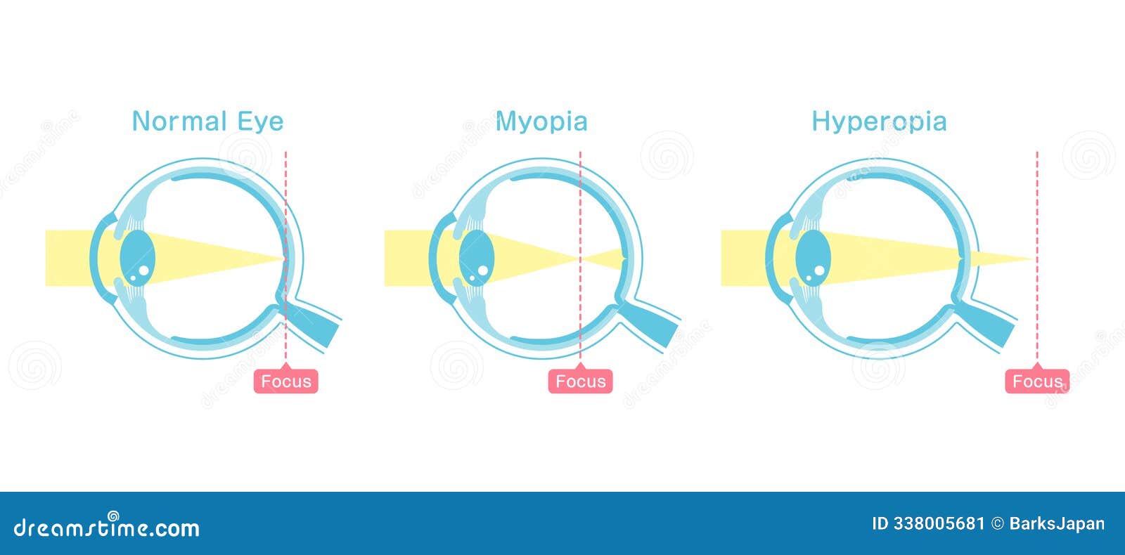 Vector Illustration of Normal Vision and Myopia and Hyperopia Stock ...