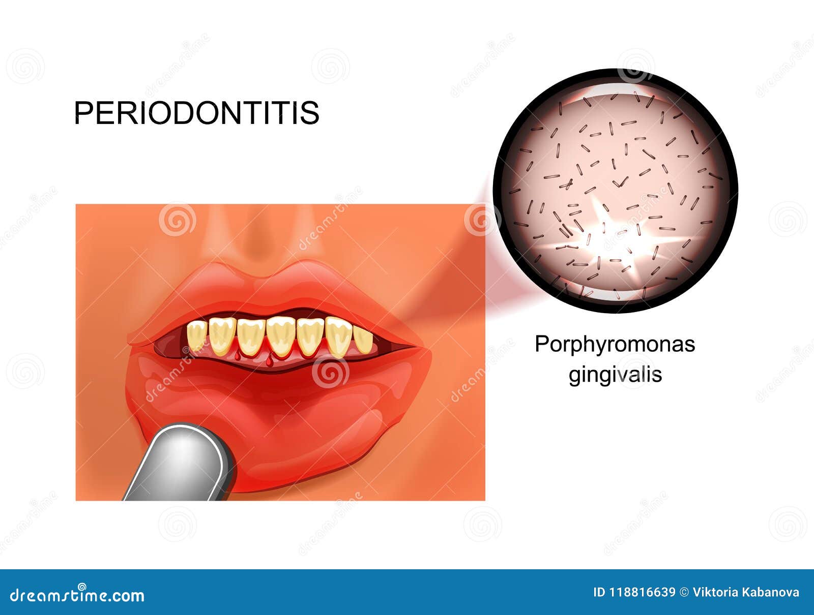 Candidiasis And Aphthous Stomatitis Vector Illustration 118643342