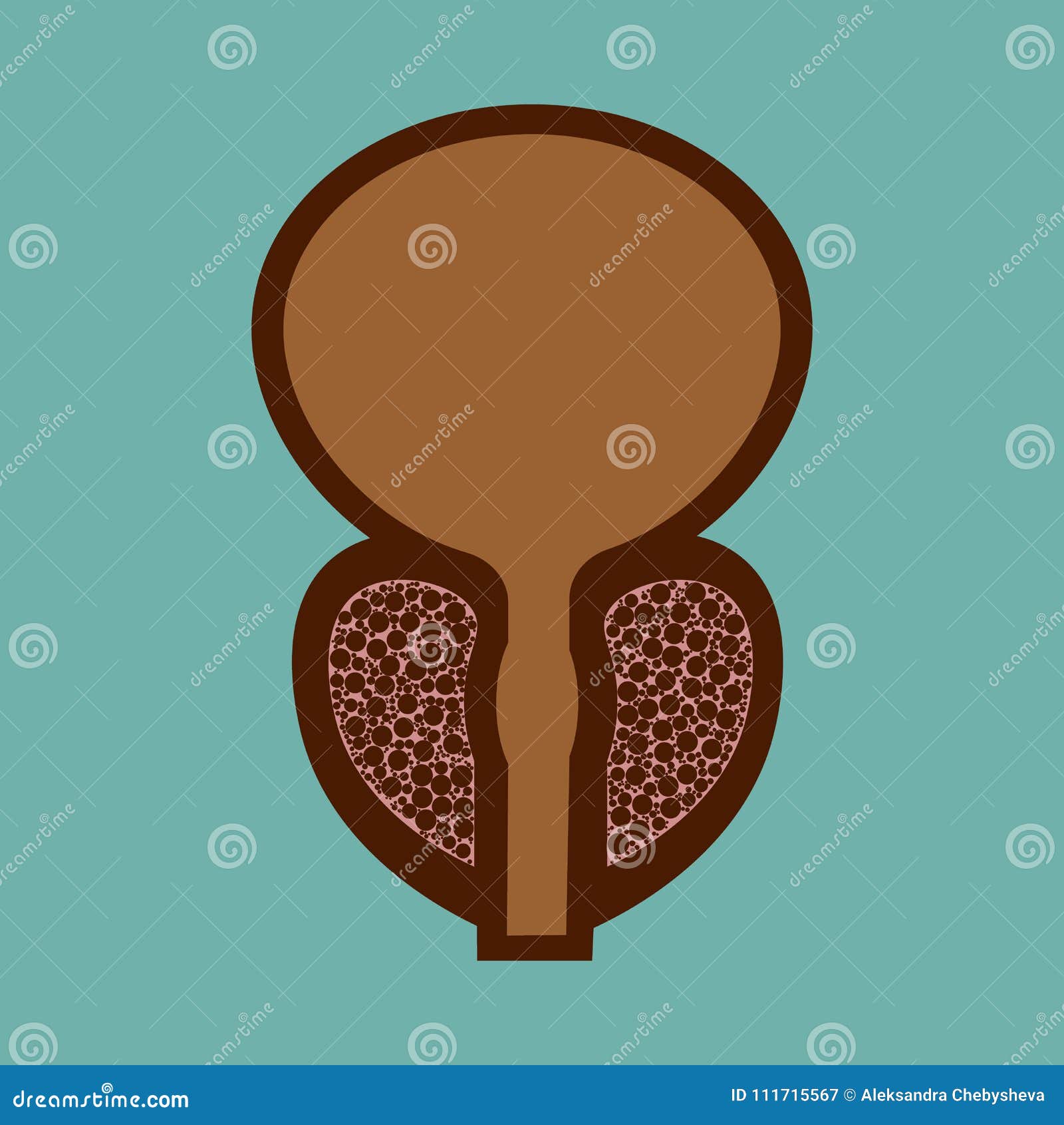 Illustration Of Prostatitis Diagram Normal Vs Enlarged Prostate Cartoon ...