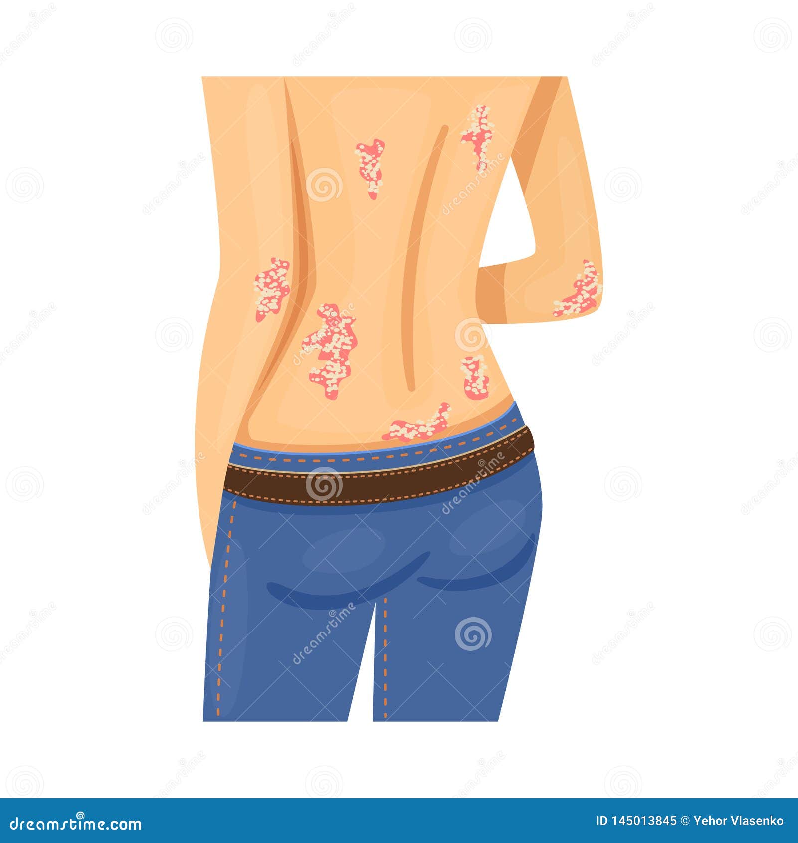 Vector Illustration Of Psoriasis And Skin Logo Set Of Psoriasis And