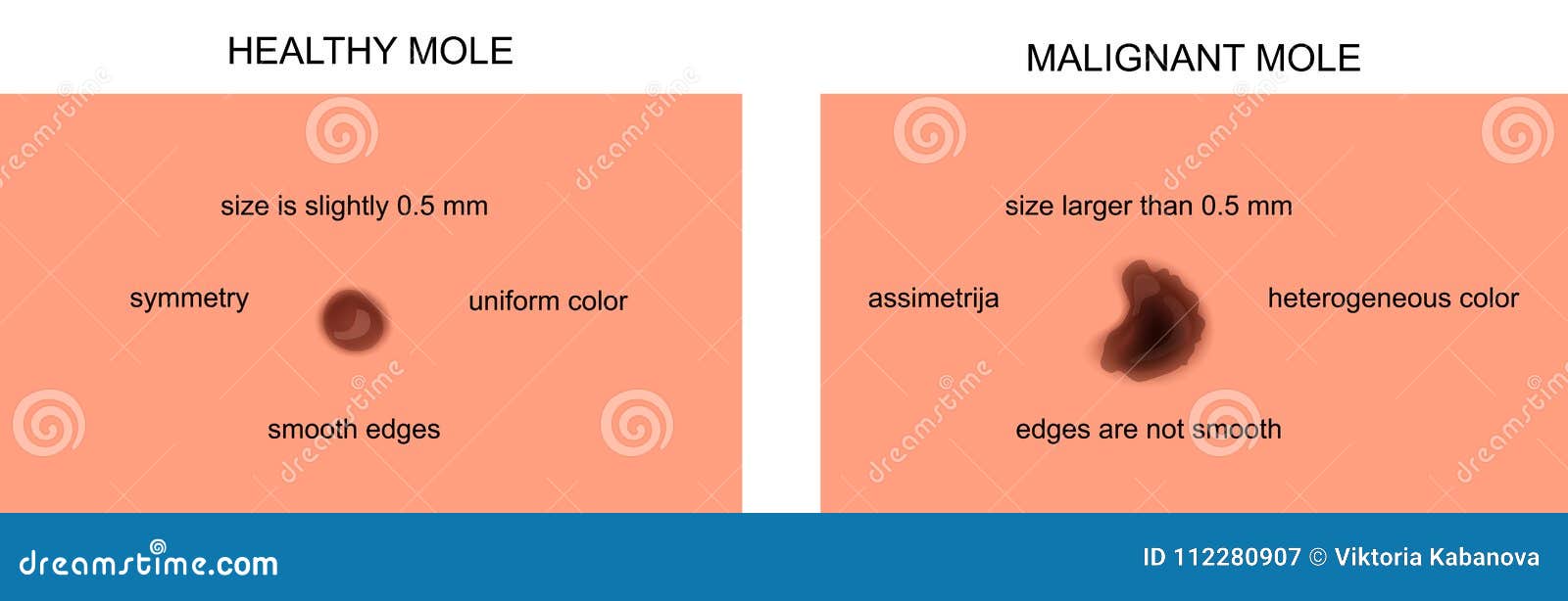 Signs Of Malignant Melanoma And Mole. Skin Cancer Vector Illustration ...