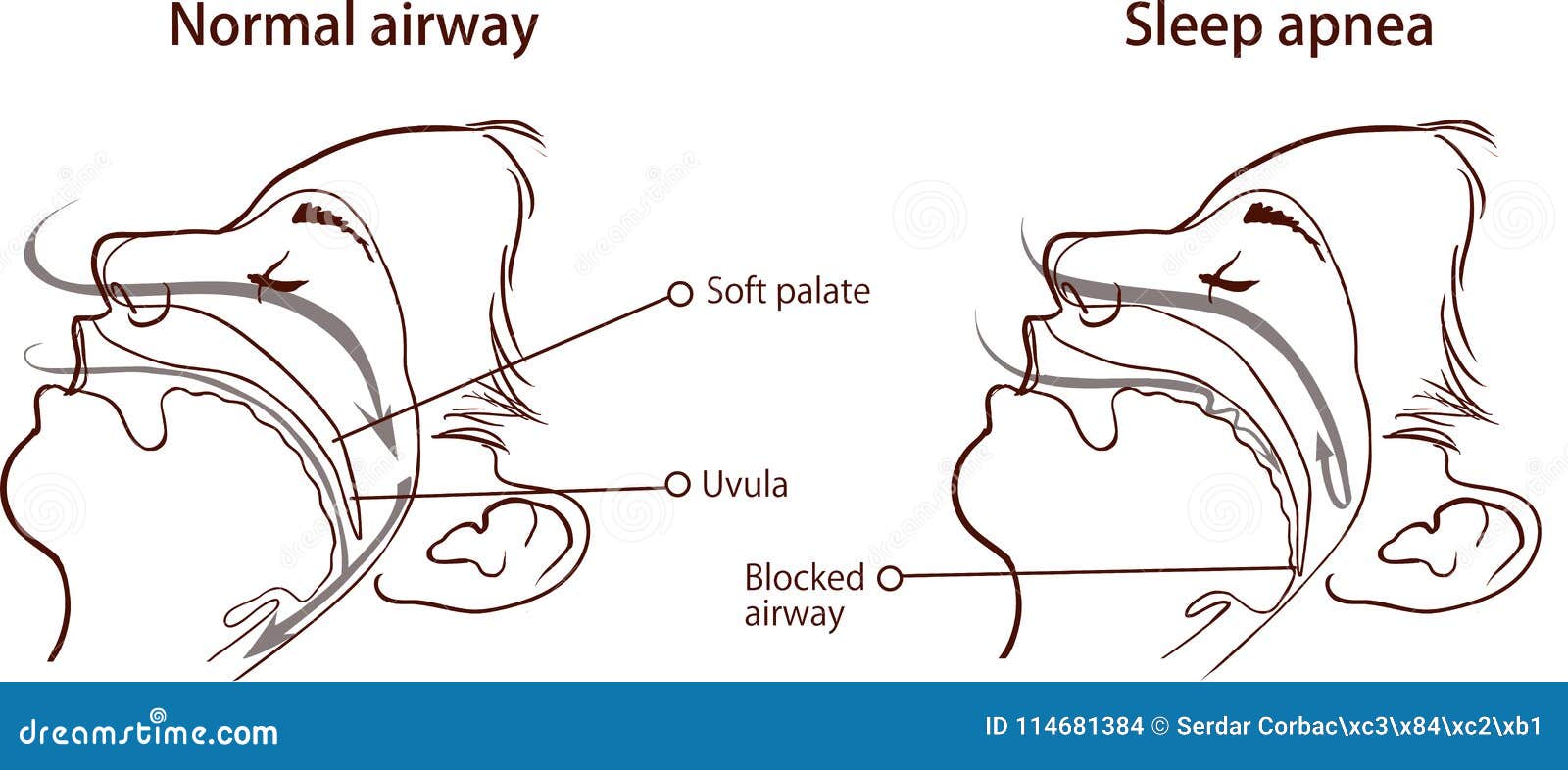 VECTOR ILLUSTRATION of a SLEEP APNEA SYNDROME Stock Vector ...