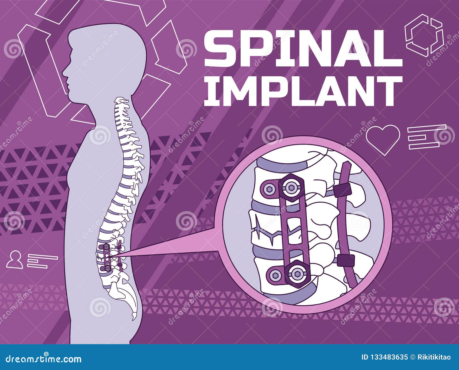 Vector Illustration of the Spinal Implant Medical Stock Vector ...