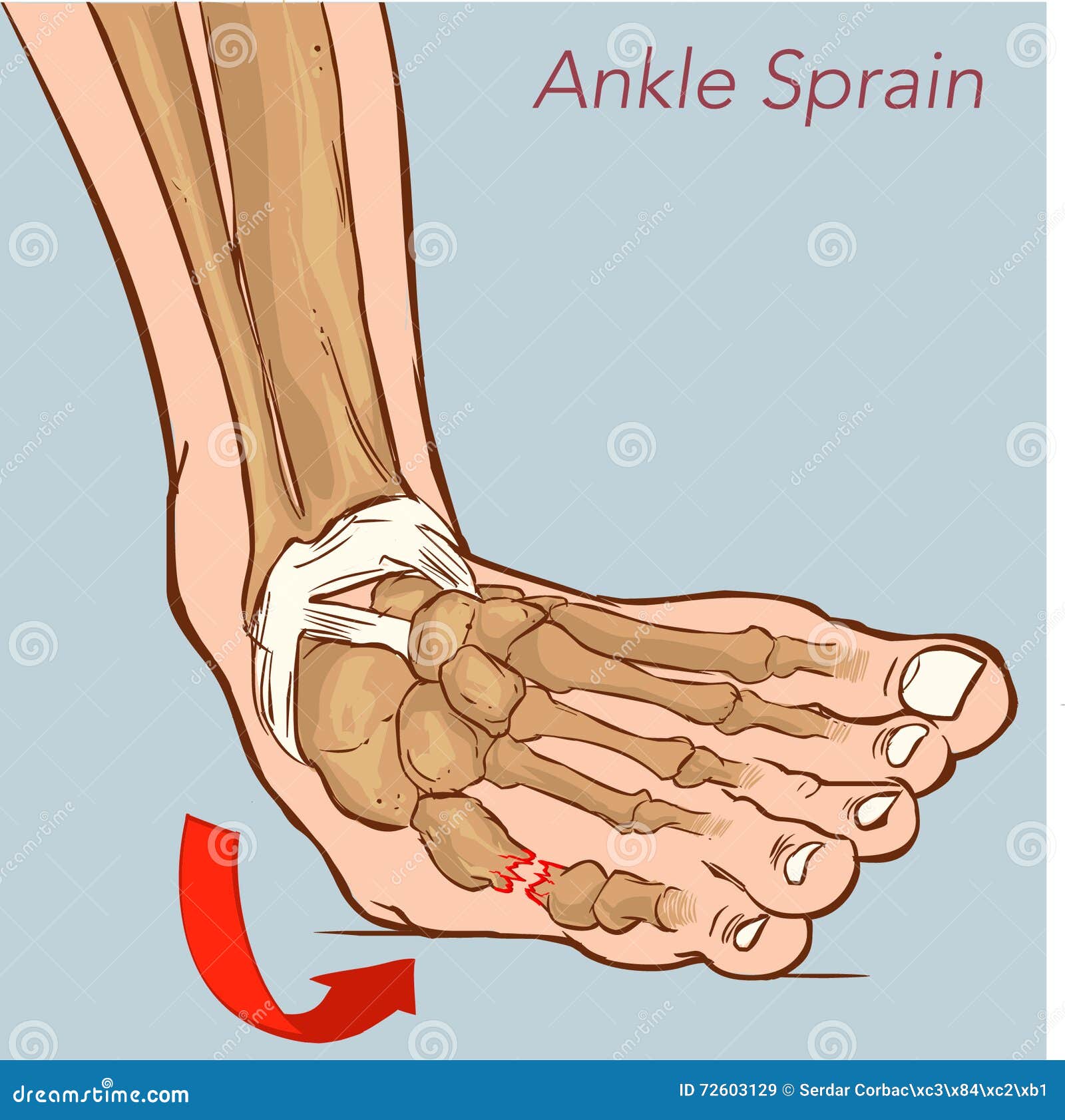 Sprained Ankle Outline Vector Icon. Thin Line Black Sprained Ankle Icon ...