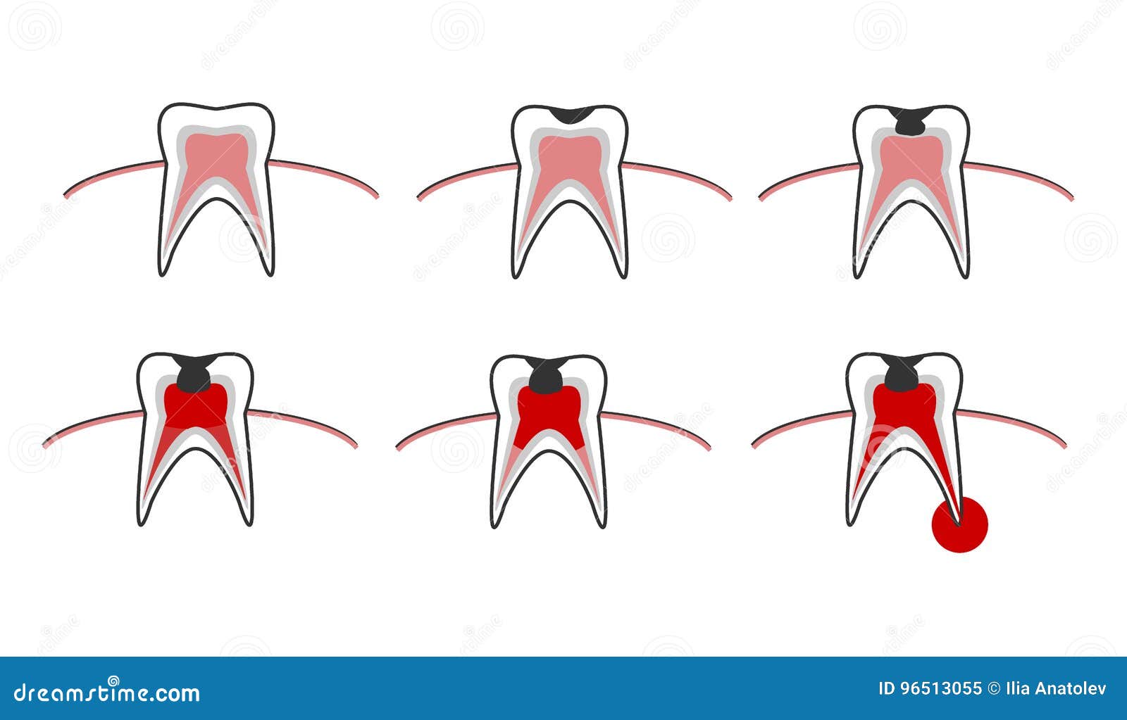 THE STAGES OF CARIES DEVELOPMENT Cartoon Vector | CartoonDealer.com ...