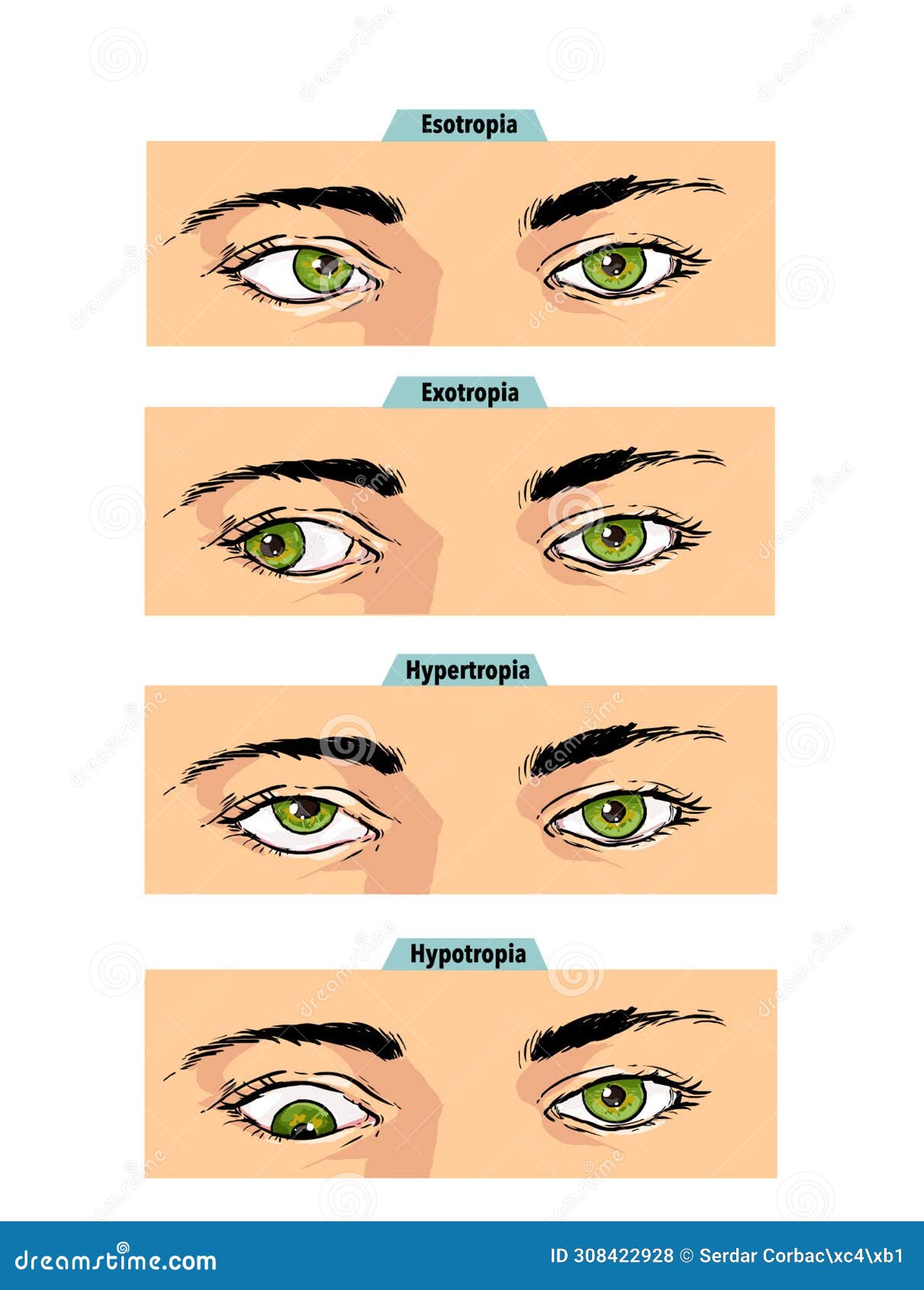 Vector Illustration of a Strabismus or Crossed Eyes Stock Vector ...