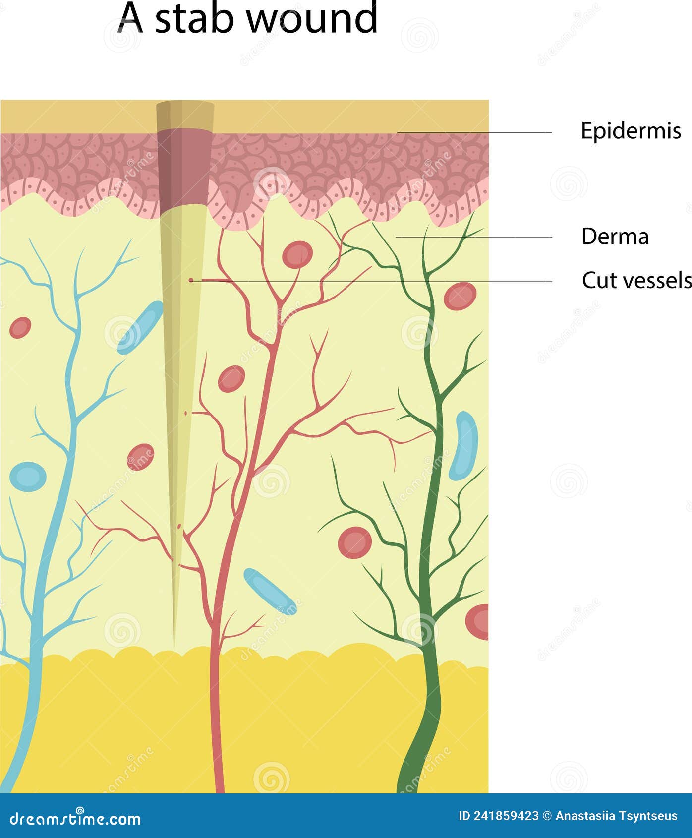 Vector Illustration of the Structure of a Stab Wound. Cut Vessels. Skin ...
