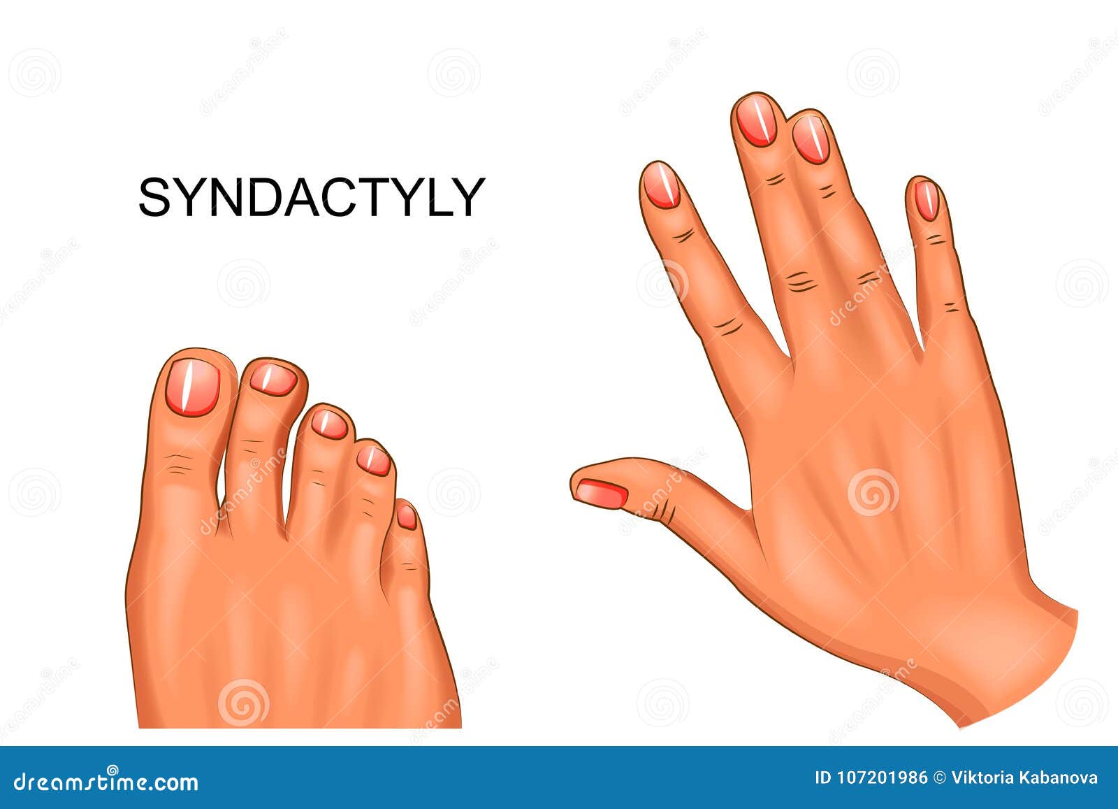 Syndactyly. Webbed Hand and Foot Stock Vector - Illustration of medical ...