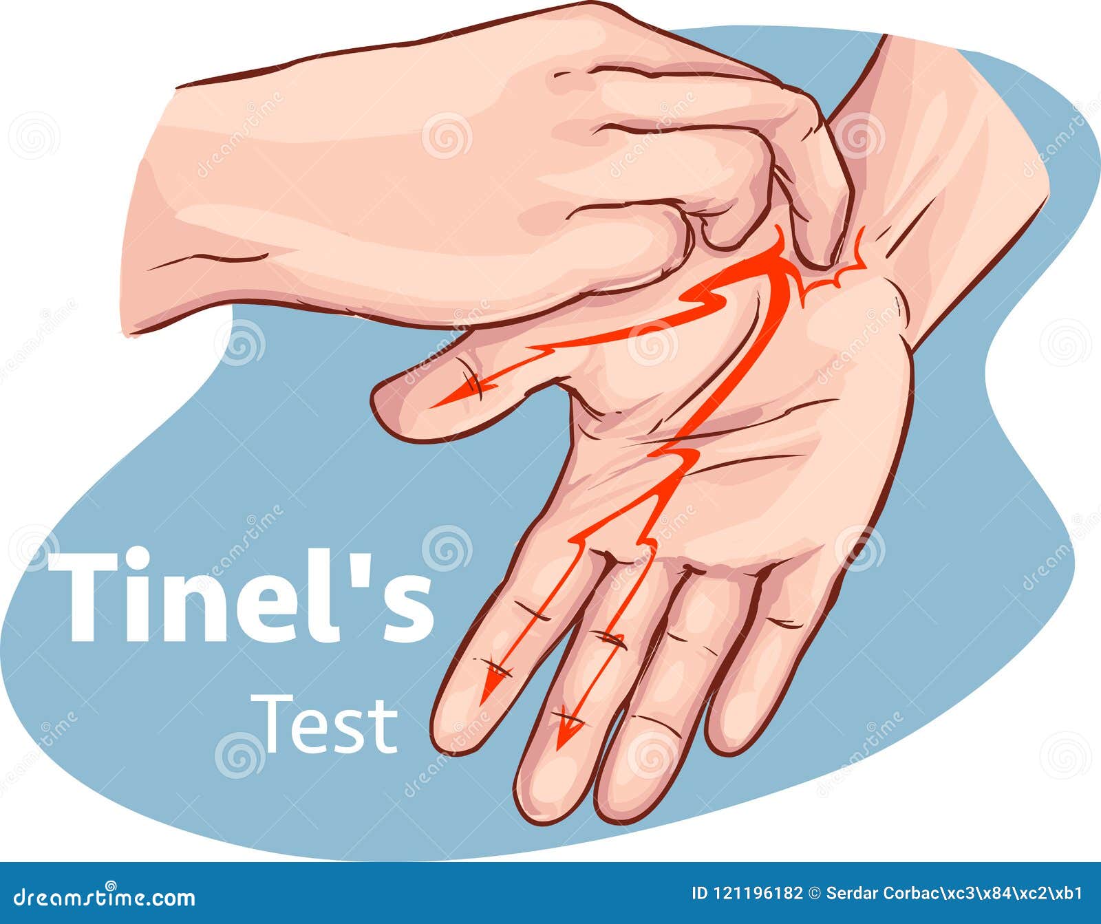 Vector Illustration of a Tinel`s Test Stock Vector - Illustration of ...