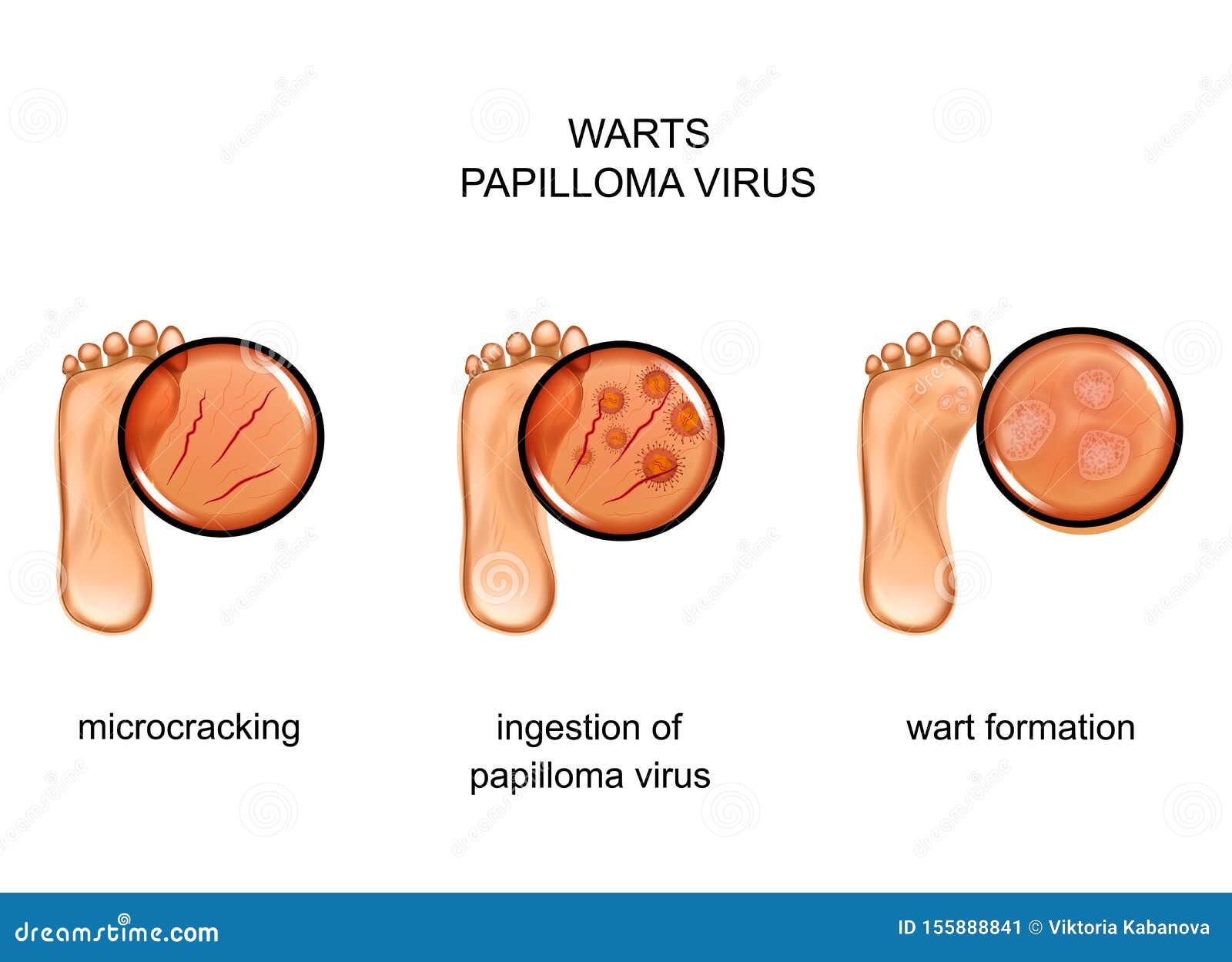Warts Cartoons, Illustrations & Vector Stock Images - 1045 Pictures to ...